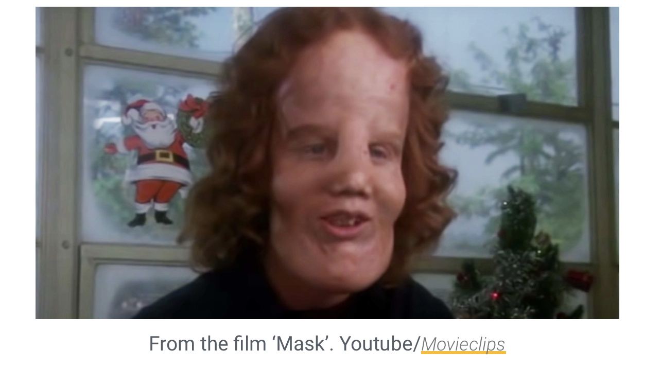 The incredible life of Rocky Dennis - the boy whose rare deformity ...