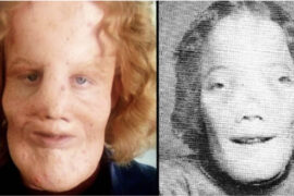The incredible life of Rocky Dennis - the boy whose rare deformity ...