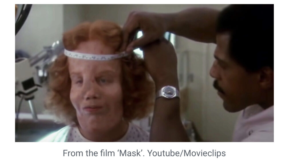 The incredible life of Rocky Dennis - the boy whose rare deformity ...