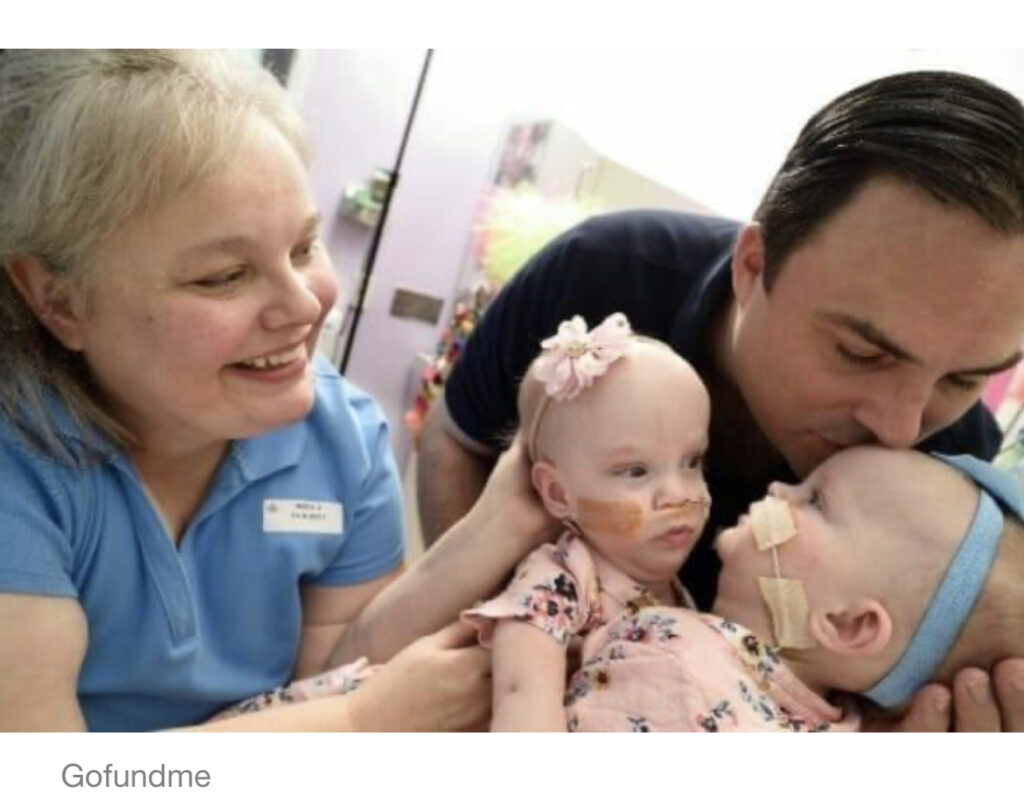 Siamese twins separated after 7-hour surgery – see how they look after ...