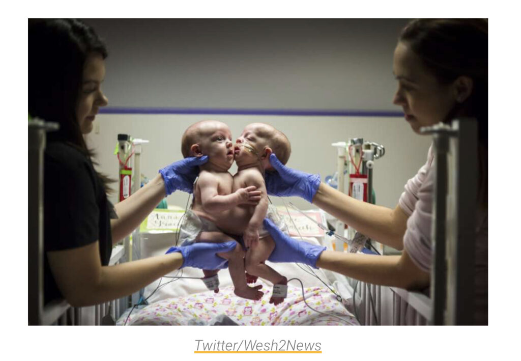 Siamese twins separated after 7-hour surgery – see how they look after unique operation - Info ...