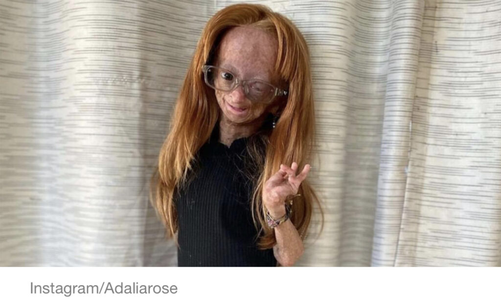 Adalia Rose Williams – the girl with rare Early-Aging syndrome: Inside ...